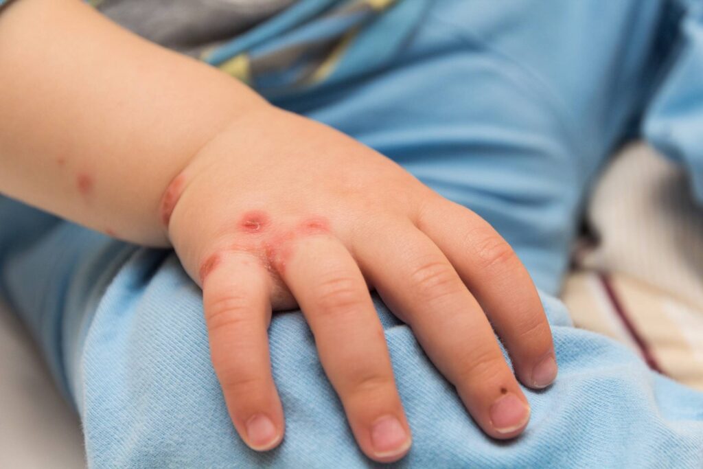 Maymun Çiçeği Virüsü nedir? Hastalığı, belirtileri, bitkisi, tedavisi